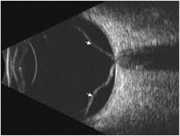 ECHO-B-SCAN ULTRASOUND - Acura Eye Clinic & Aesthetics